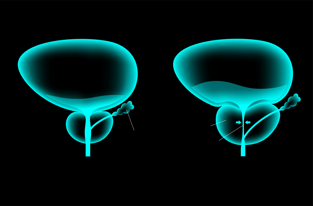 Urologista Goiânia - A RTU de próstata e as opções de vaporização - Dr ...
