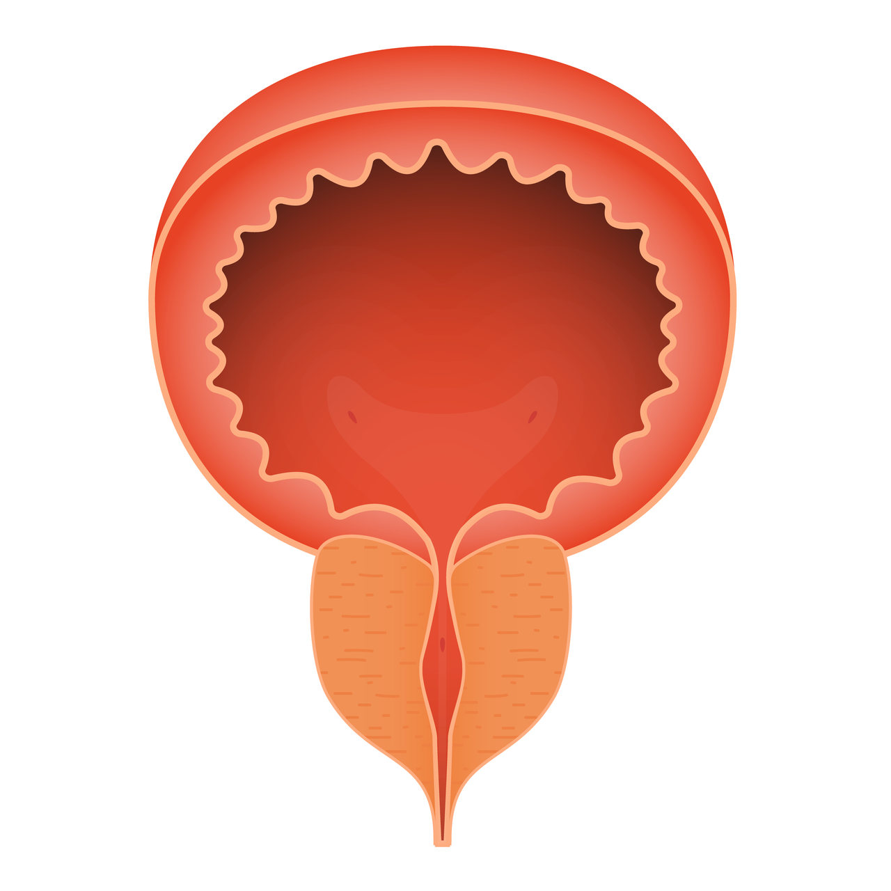 Urologista Goiânia - O que é HPB (Hiperplasia benigna da próstata ...